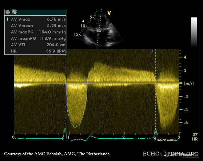 Aortic Stenosis Echo Doppler
